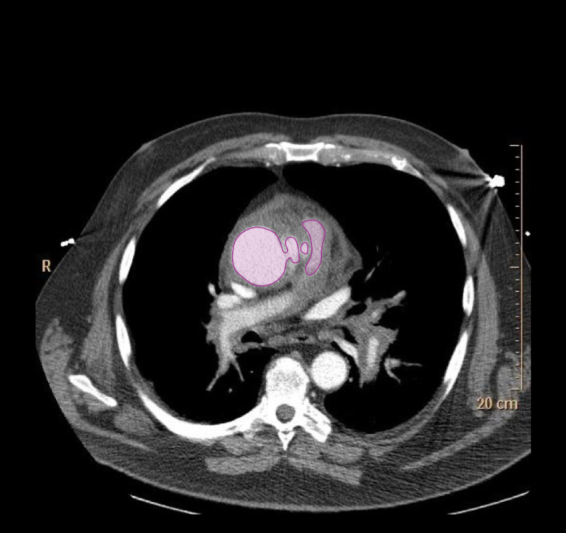 pau - Differential Diagnosis of