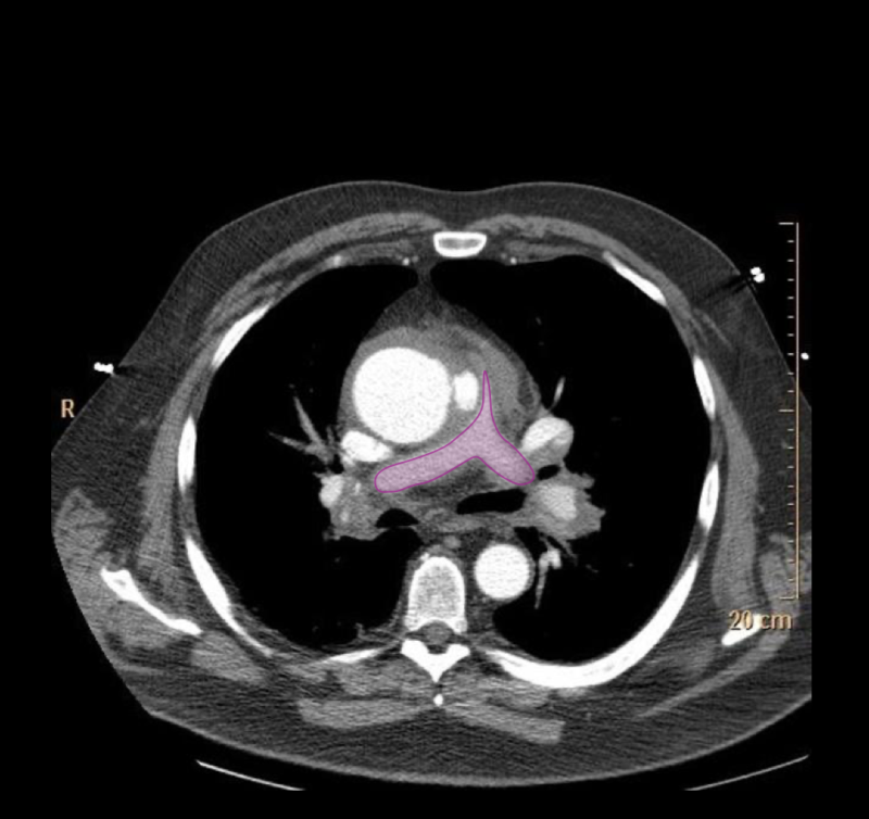 pau_hematoma_compression - Differential Diagnosis of