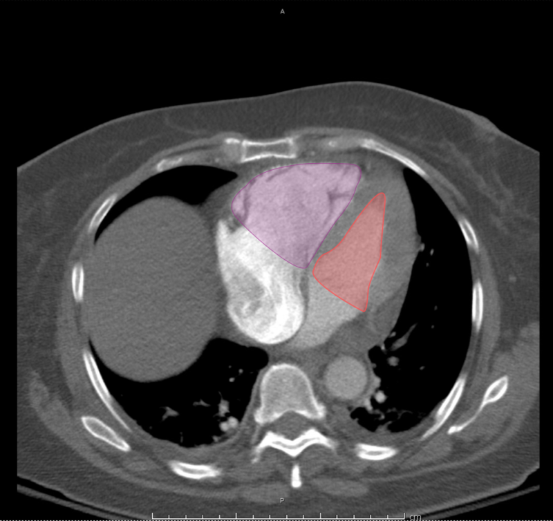 rv-dilation - Differential Diagnosis of