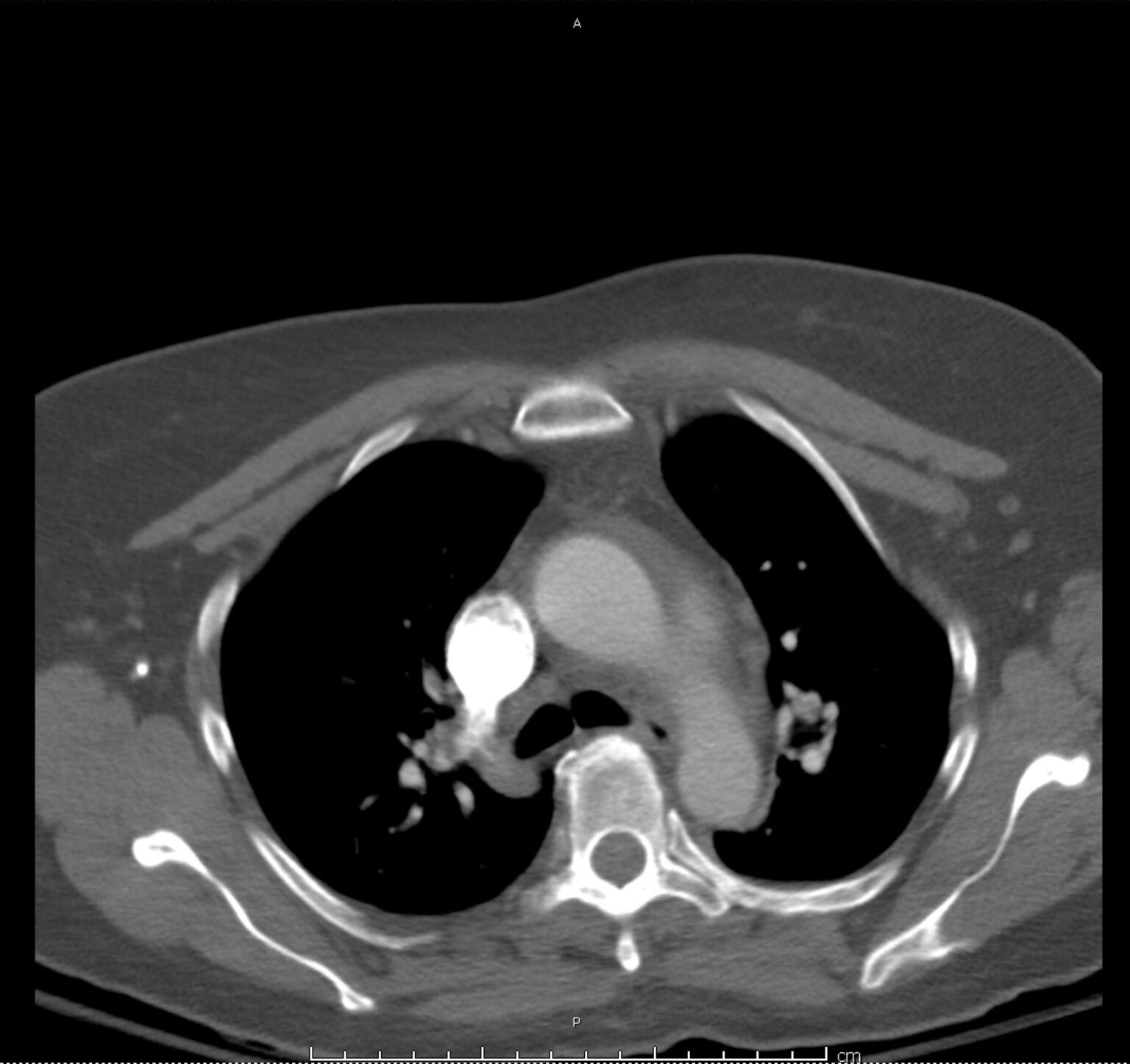 01_pe-saddle - Differential Diagnosis of