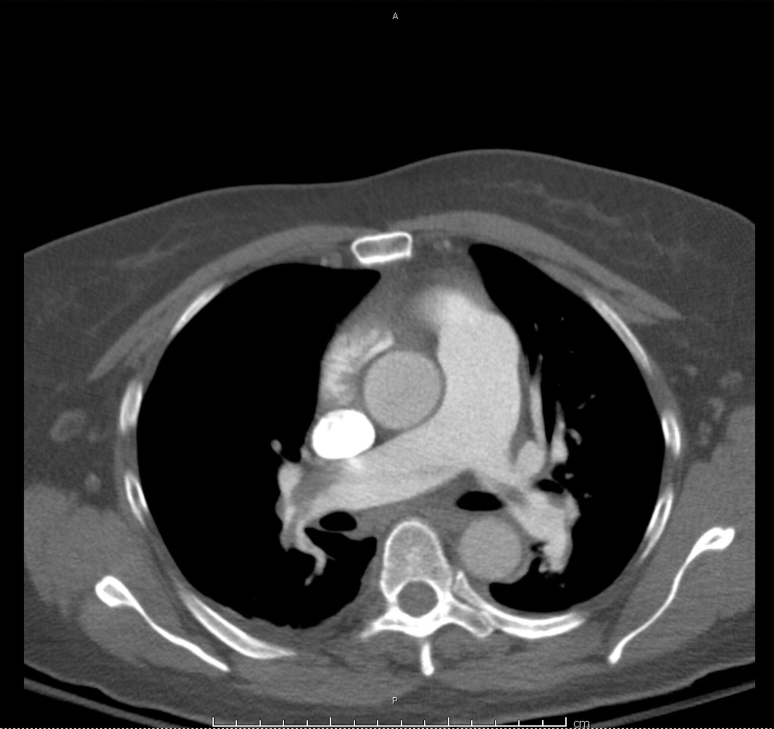 05_pe-saddle - Differential Diagnosis of