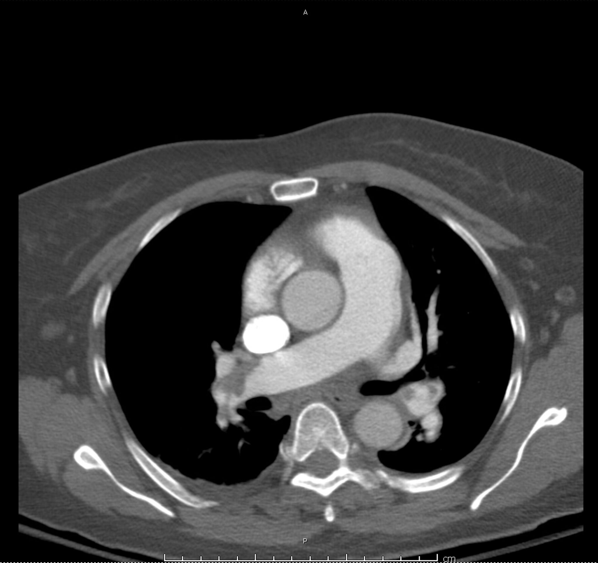 06_pe-saddle - Differential Diagnosis of
