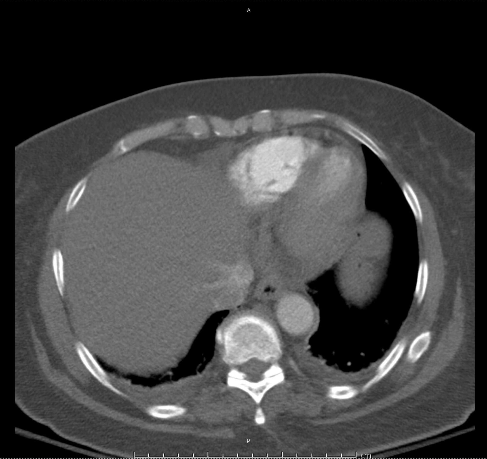 22_pe-saddle - Differential Diagnosis of