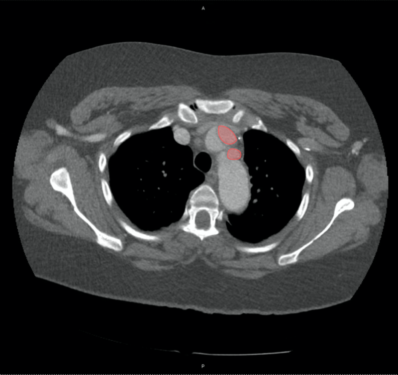 true_lumen_proximal - Differential Diagnosis of