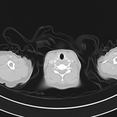 09_stridor - Differential Diagnosis of