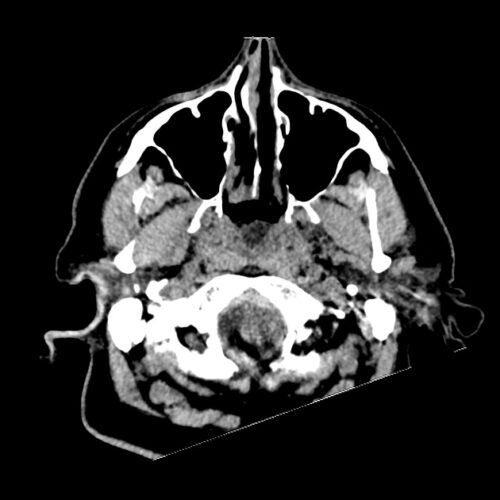 00_subdural - Differential Diagnosis of