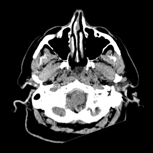 02_subdural - Differential Diagnosis of