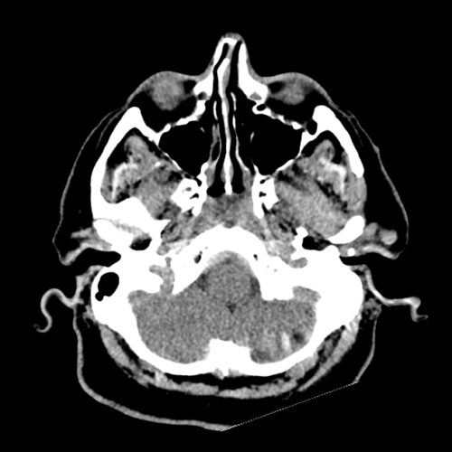 04_subdural - Differential Diagnosis of