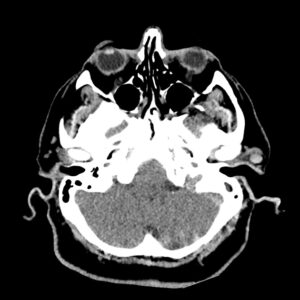 06_subdural - Differential Diagnosis of