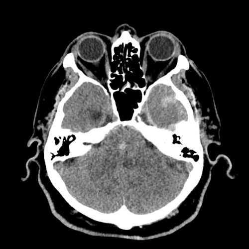 10_subdural - Differential Diagnosis of